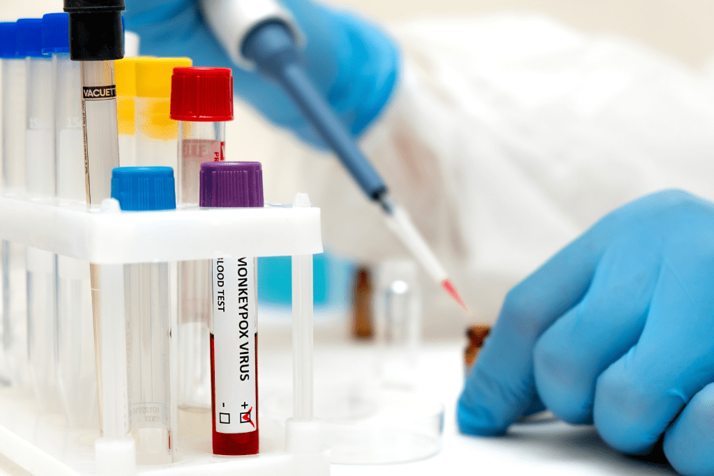 Training for health officials to detect monkeypox to start today ...