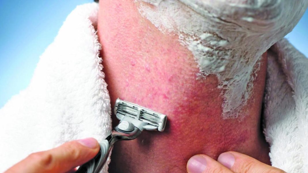 TREATMENT AND PREVENTION OF RAZOR BUMPS - Guyana Times