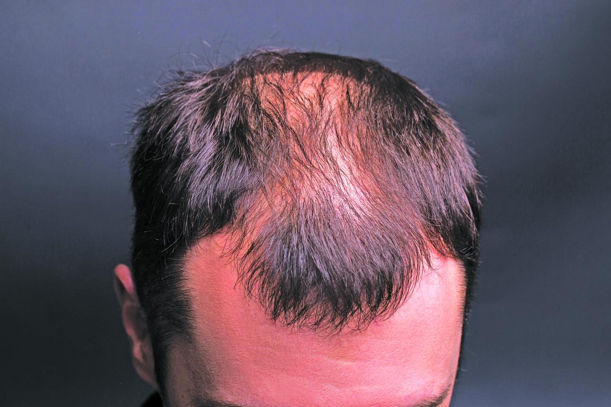 MEN’S HEALTH MONTH - HAIR LOSS - Guyana Times