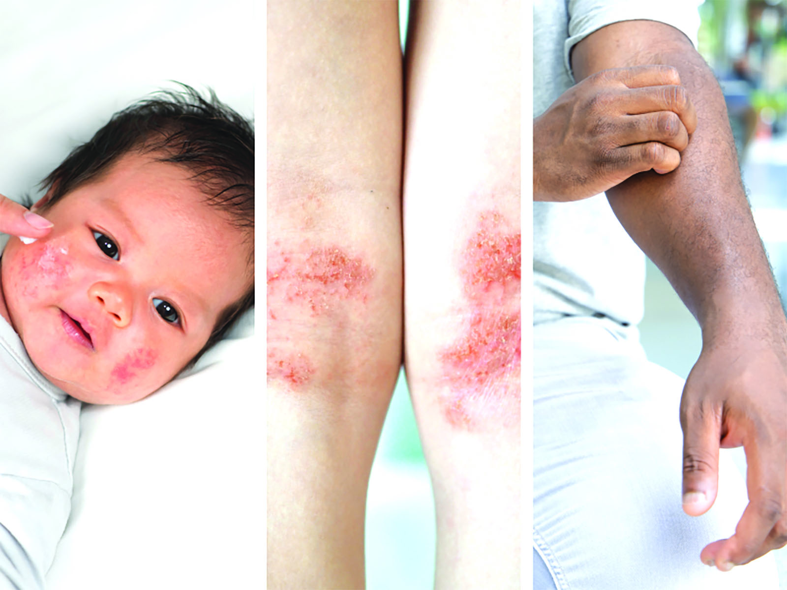 SKIN FLARE-UPS – ATOPIC DERMATITIS - Guyana Times